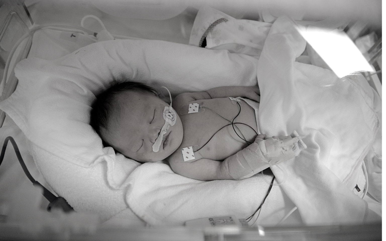 Subgaleal Hemorrhage In Newborns Due To Medical Malpractice?